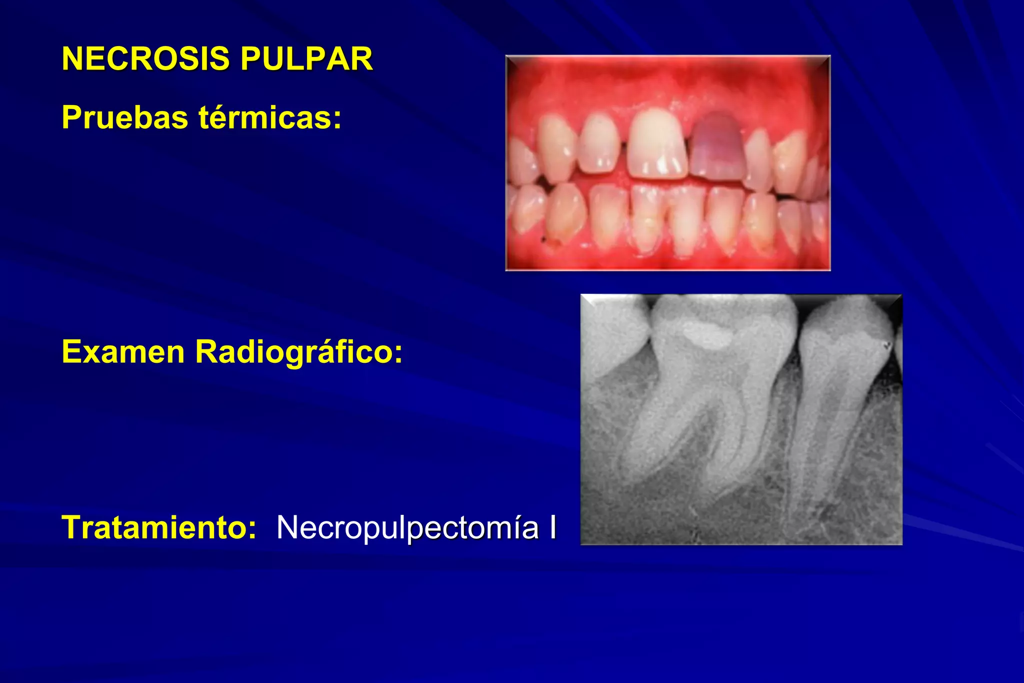 Alteraciones pulpares y periapicales | PDF