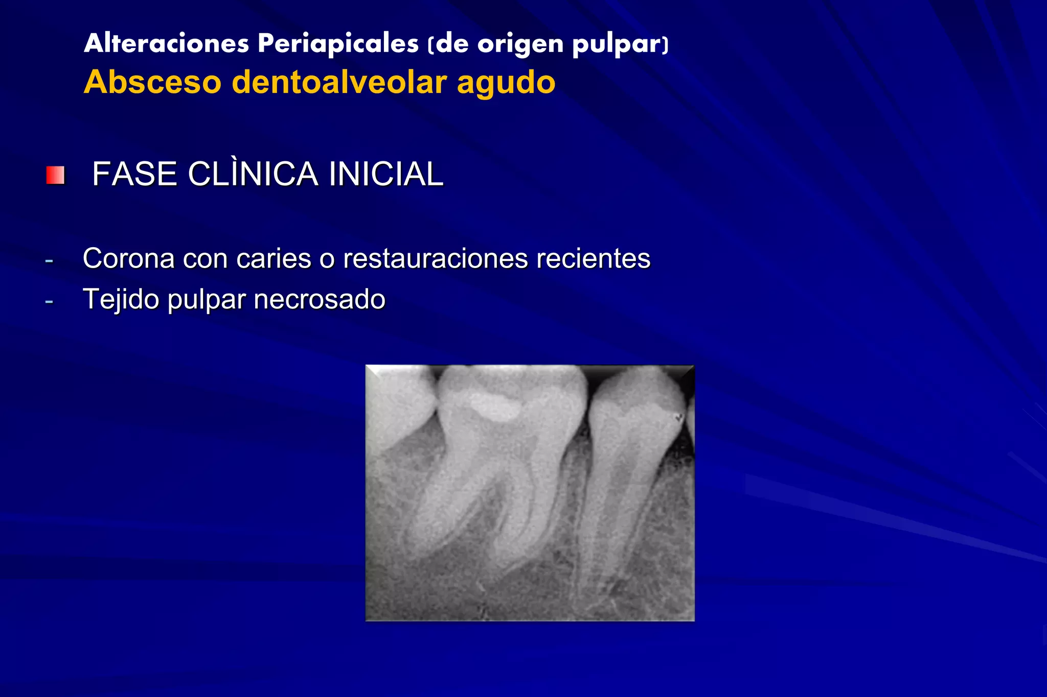 Alteraciones pulpares y periapicales | PDF