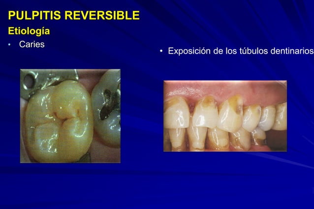 Alteraciones pulpares y periapicales | PDF