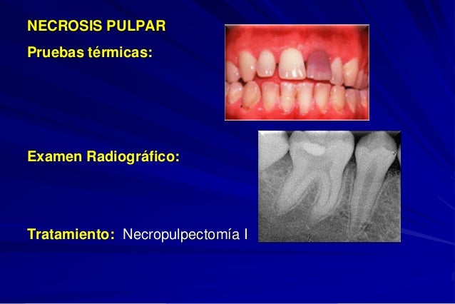 Alteraciones pulpares y periapicales