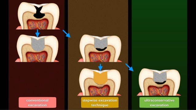 Prevent unnecessary endo tx