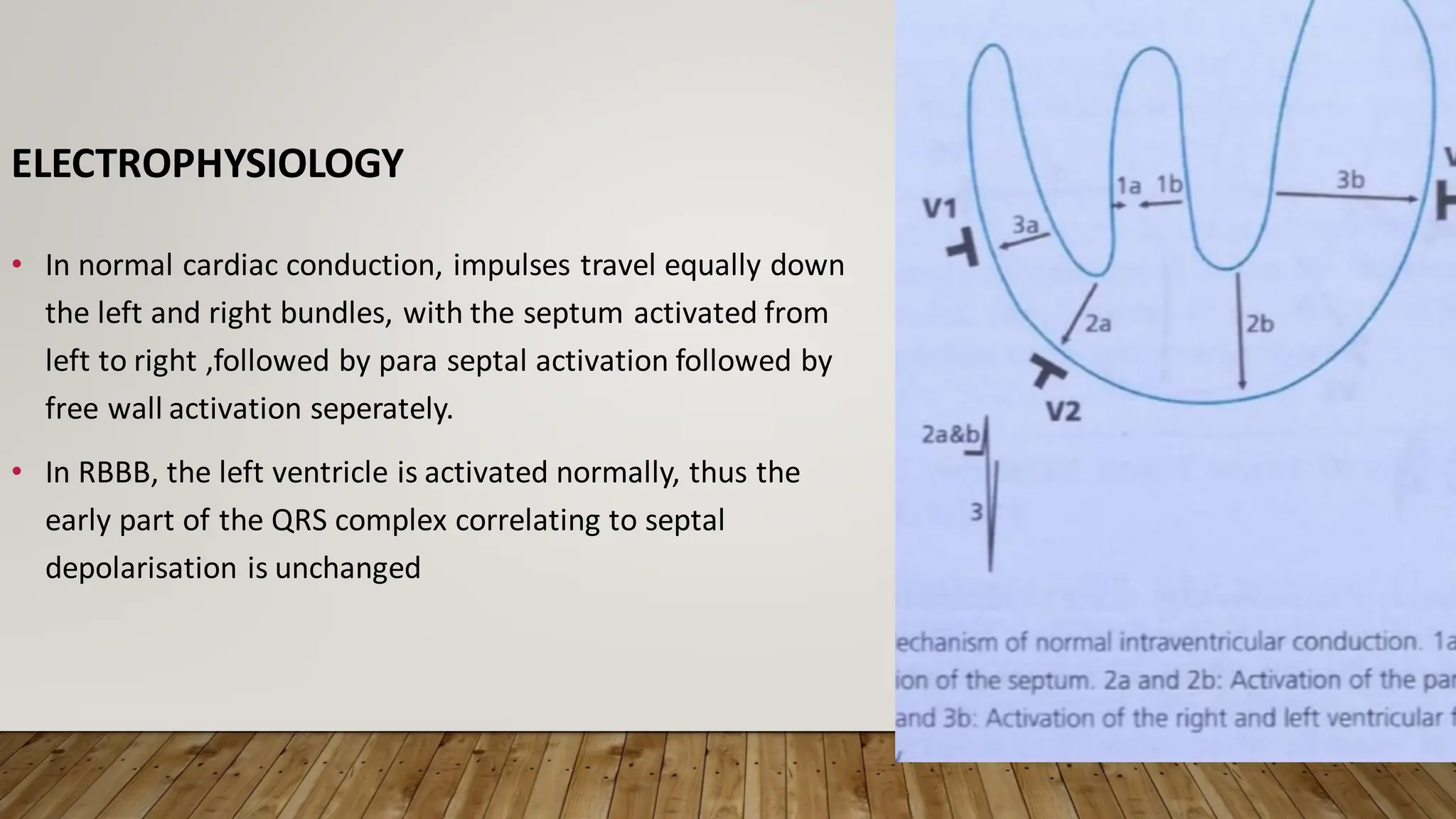 right bundle branch block ,rbbb,right heart failure | PDF