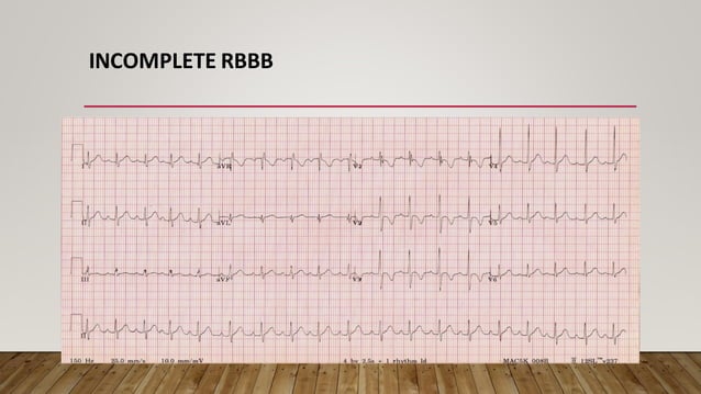right bundle branch block ,rbbb,right heart failure | PDF