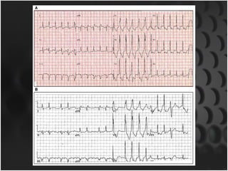 RBBB with STEMI | PPT