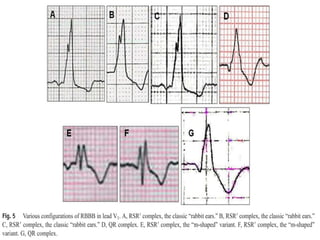 RBBB with STEMI | PPT