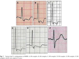 RBBB with STEMI | PPT