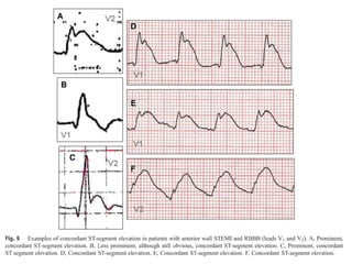 RBBB with STEMI | PPT
