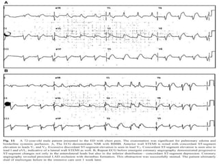 RBBB with STEMI | PPT