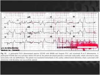 RBBB with STEMI | PPT