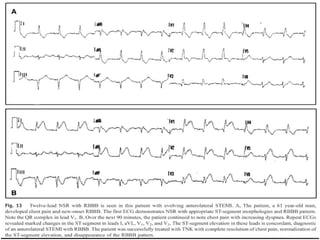 RBBB with STEMI | PPT