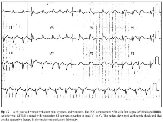 RBBB with STEMI | PPT