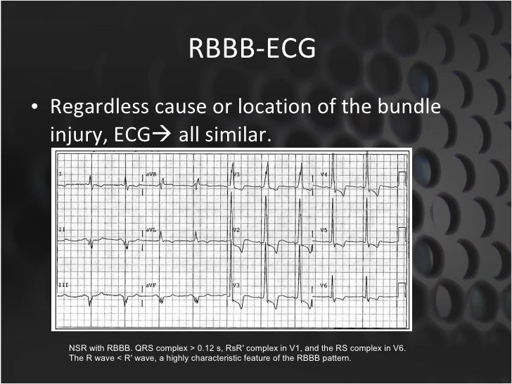 RBBB with STEMI