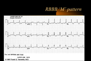 Rbbb final | PPT