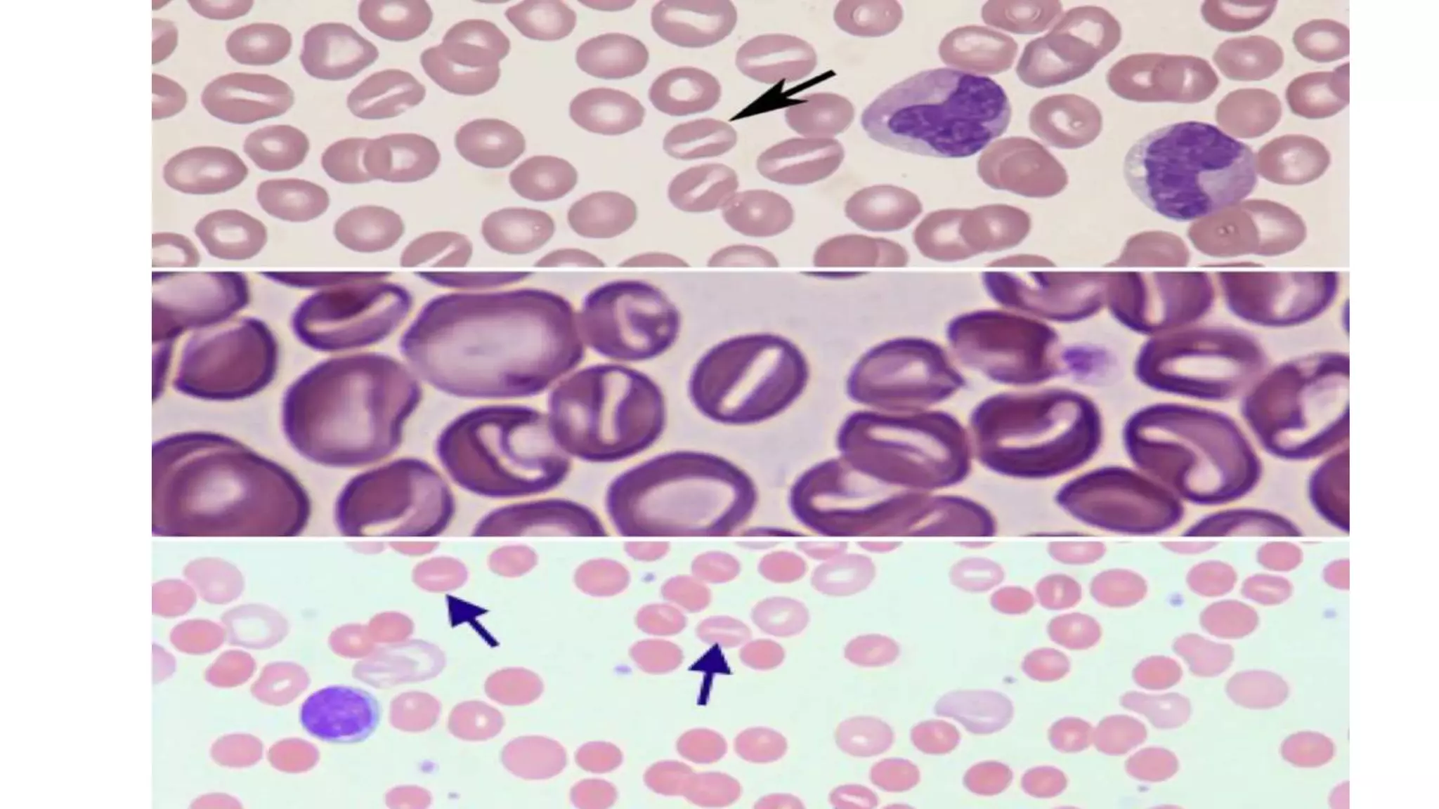 RBC.pptx | Blood Disorders | Diseases and Conditions
