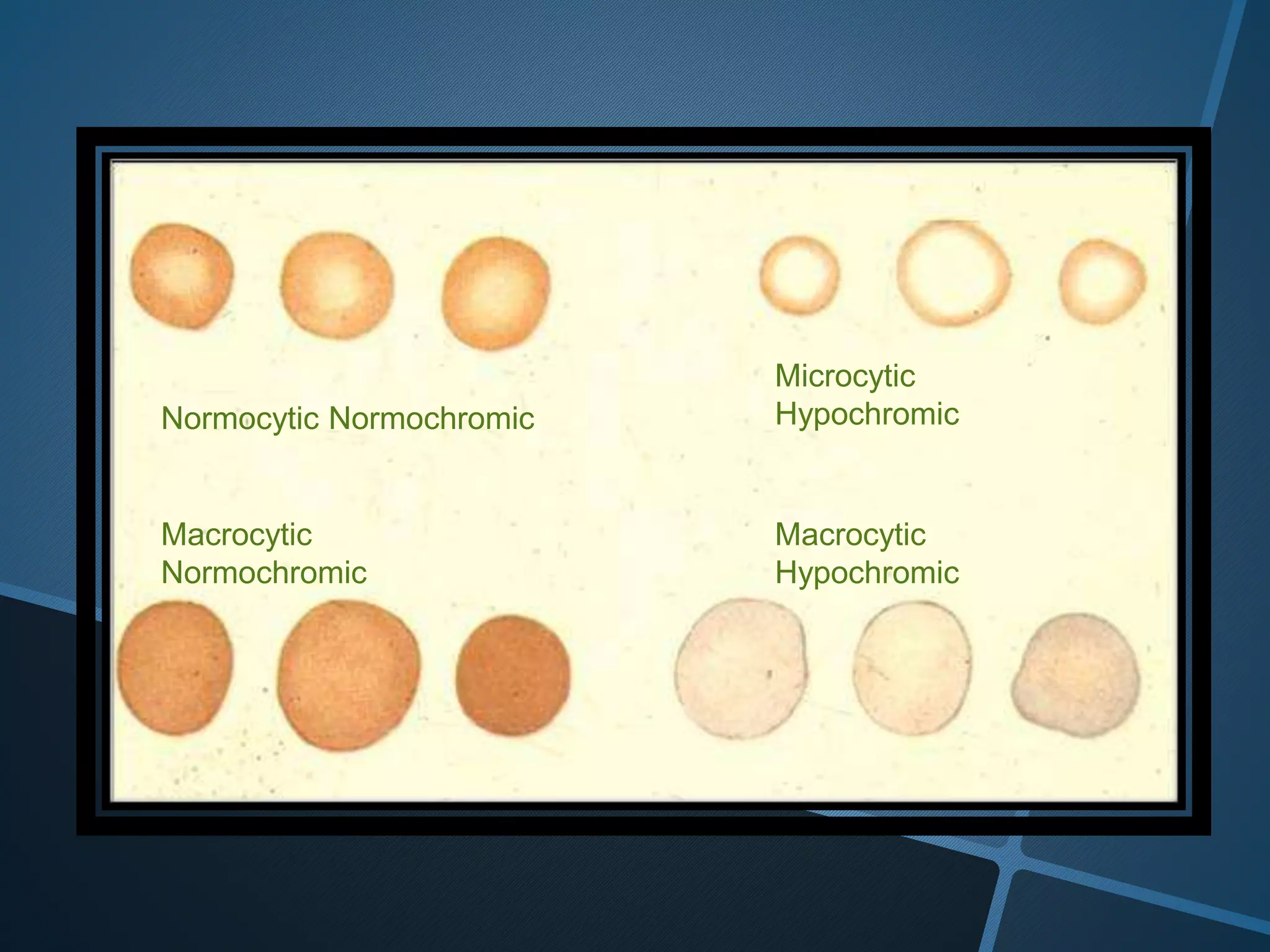 RBC Indices and Their Role in Differential Diagnosis of different types of Anemias: A Review | PPT