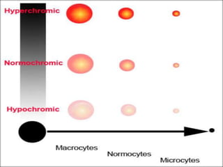 RBC Indices and Their Role in Differential Diagnosis of different types ...