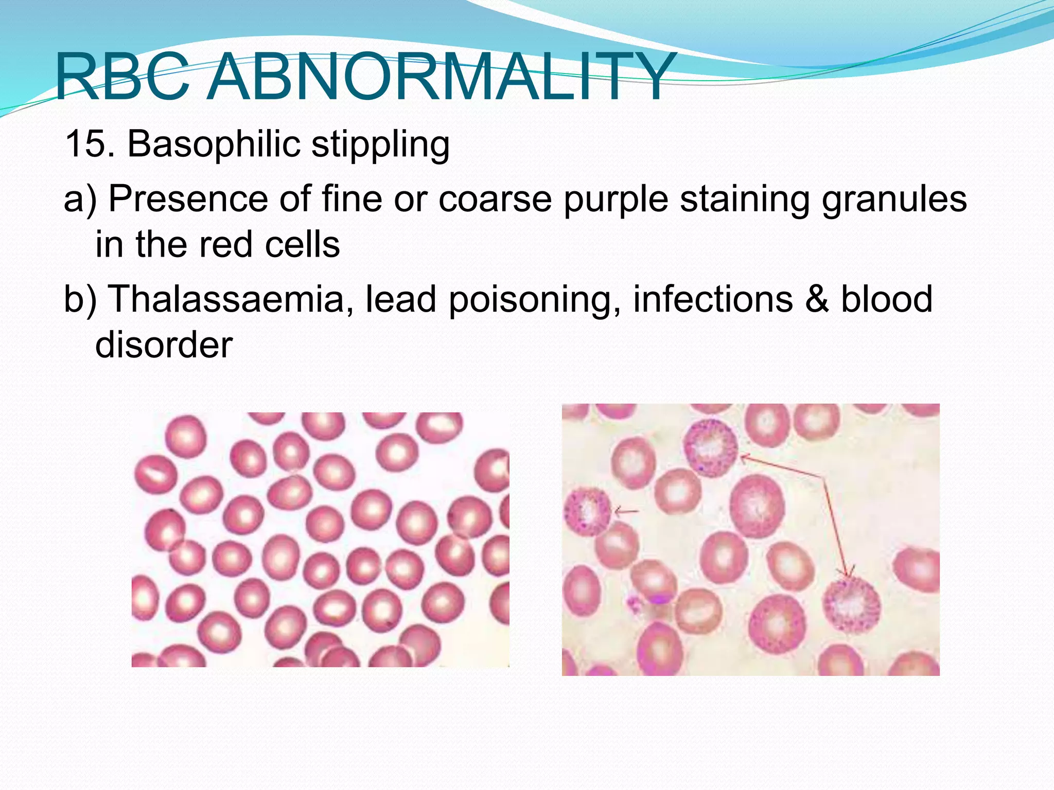 Rbc abnormality | PPTX | Blood Disorders | Diseases and Conditions
