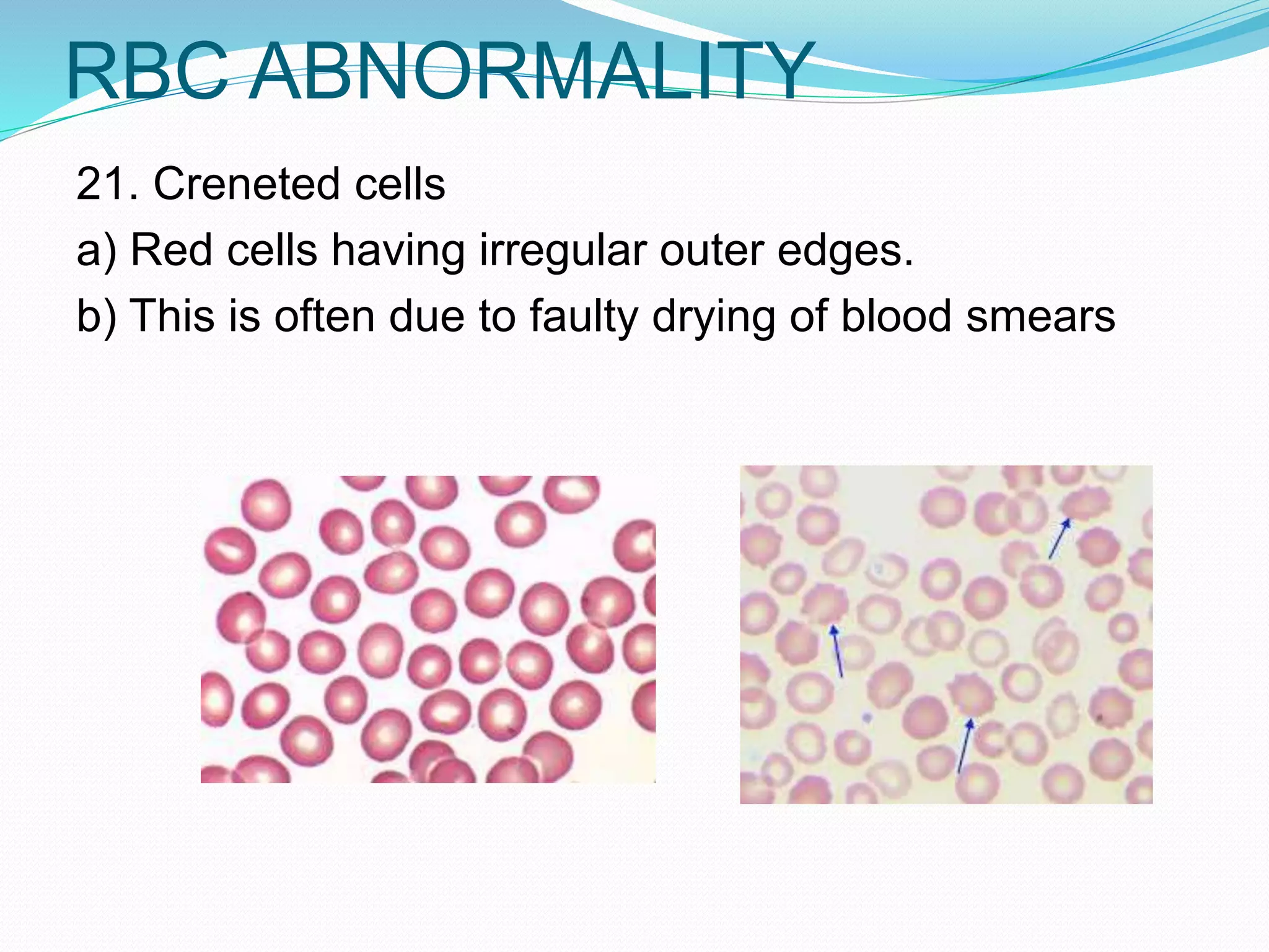 Rbc abnormality | PPTX