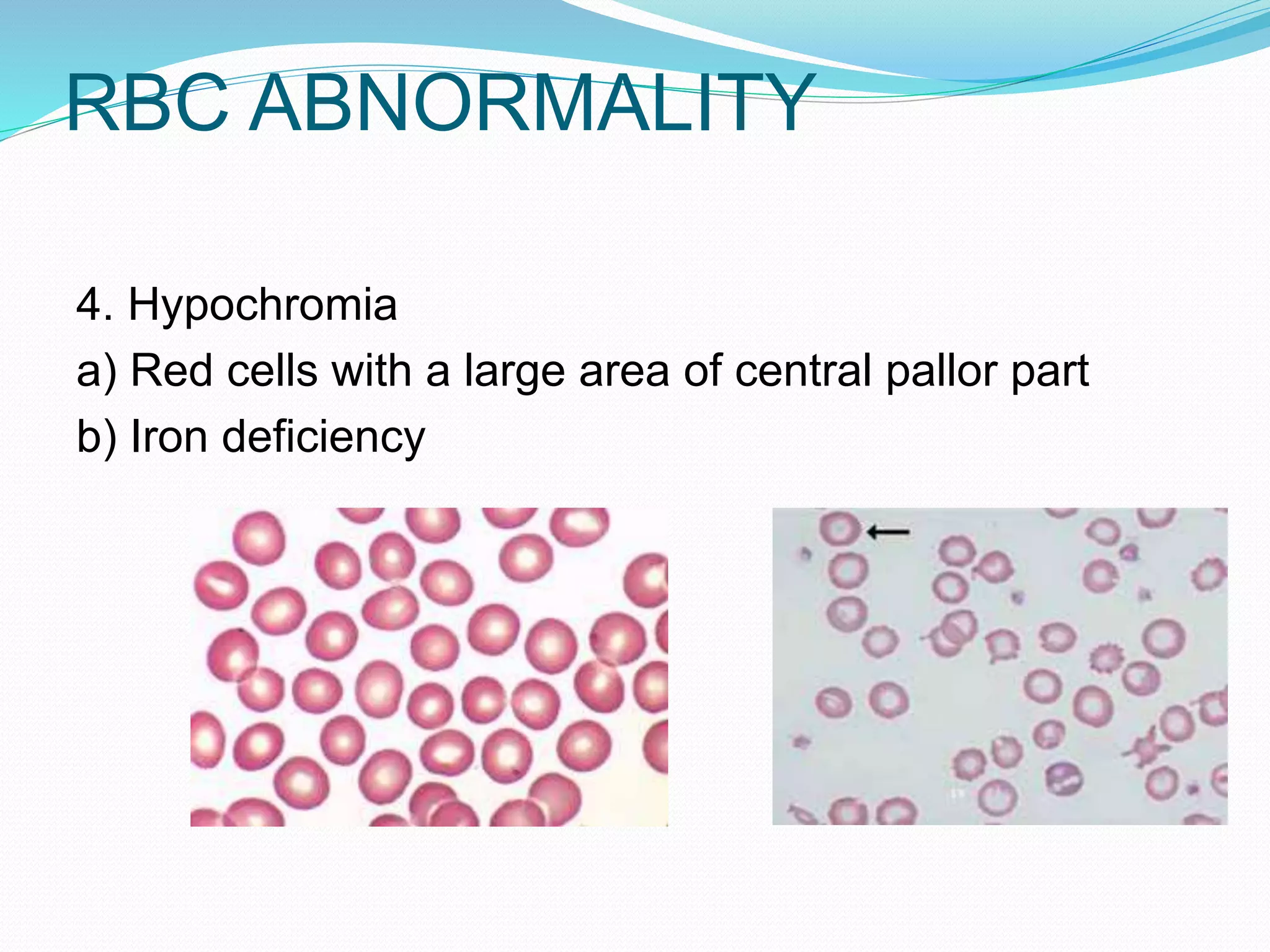 Rbc abnormality | PPTX