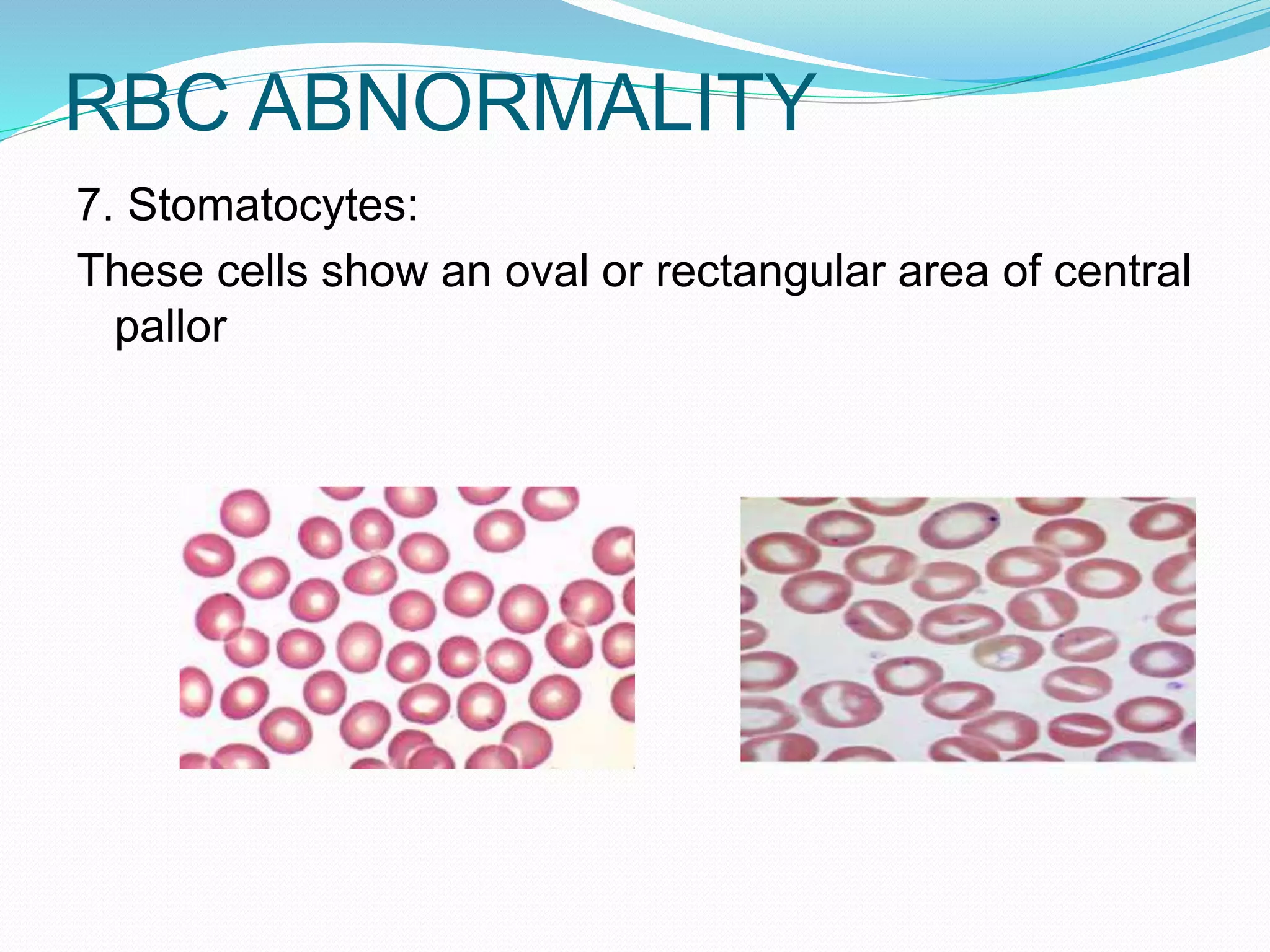 Rbc abnormality | PPTX