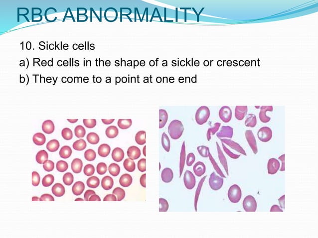 Rbc abnormality | PPTX | Blood Disorders | Diseases and Conditions