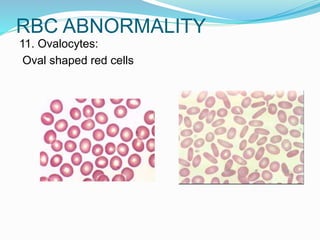 Rbc abnormality | PPTX