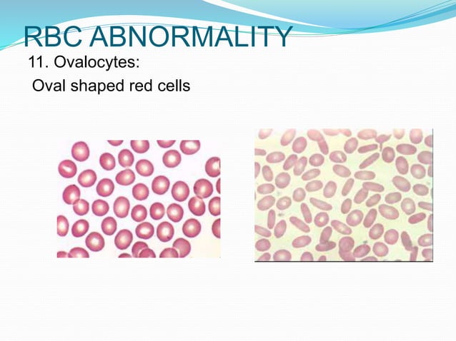 Rbc abnormality | PPTX | Blood Disorders | Diseases and Conditions