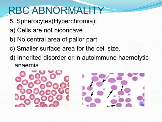 Rbc abnormality | PPTX | Blood Disorders | Diseases and Conditions