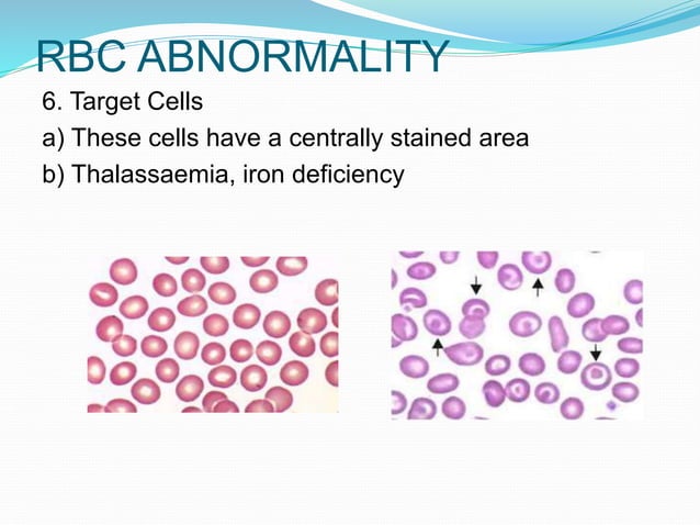 Rbc abnormality | PPTX | Blood Disorders | Diseases and Conditions