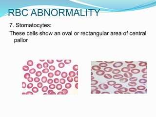Rbc abnormality | PPTX | Blood Disorders | Diseases and Conditions