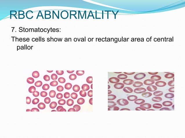 Rbc abnormality | PPTX | Blood Disorders | Diseases and Conditions