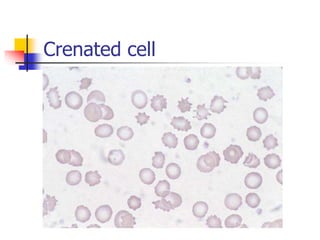 RBC & Anaemia other than H.A.pptpathology | PPT