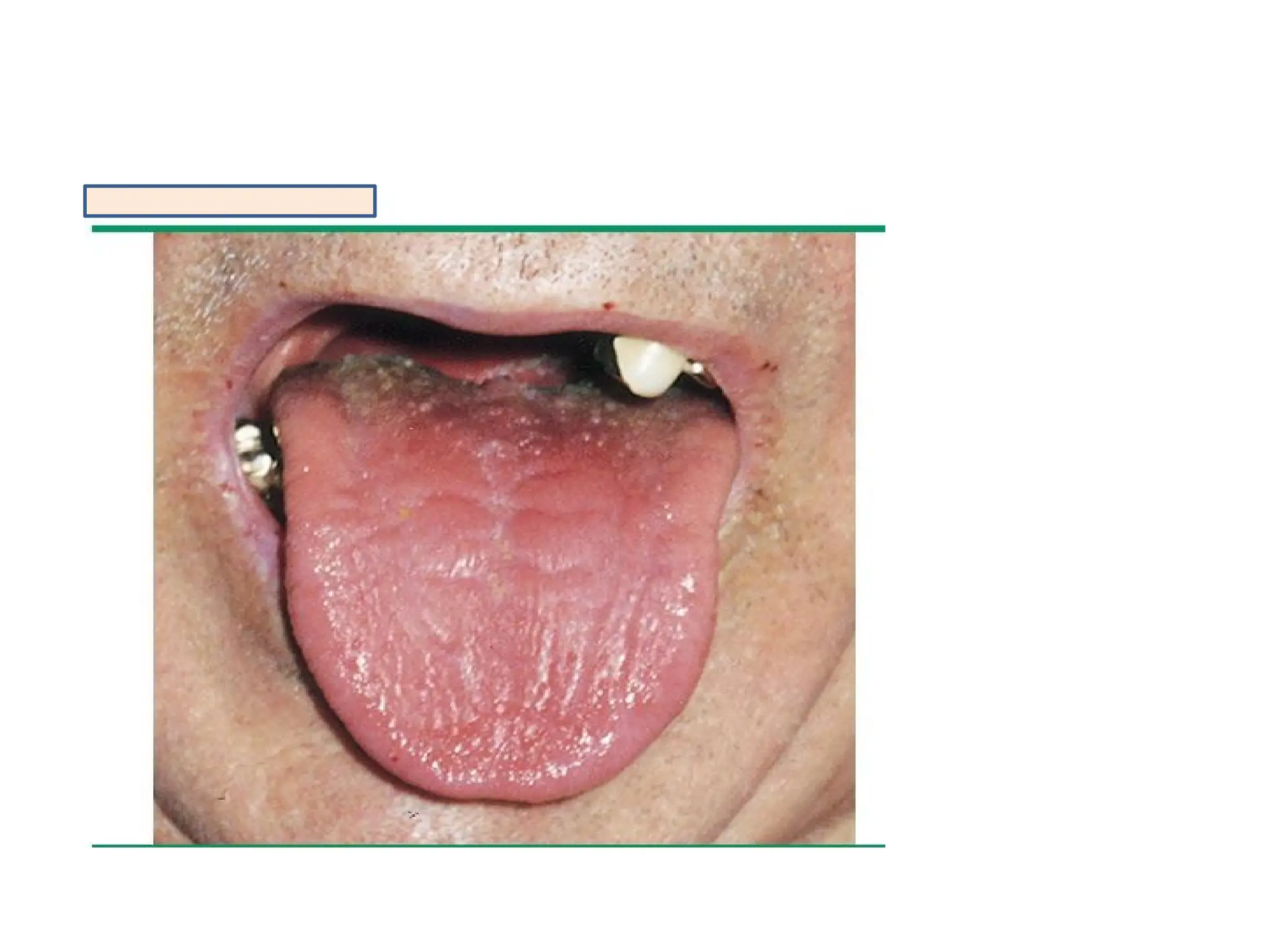 Approach to RBC disorders, anemia microcytic | PPT