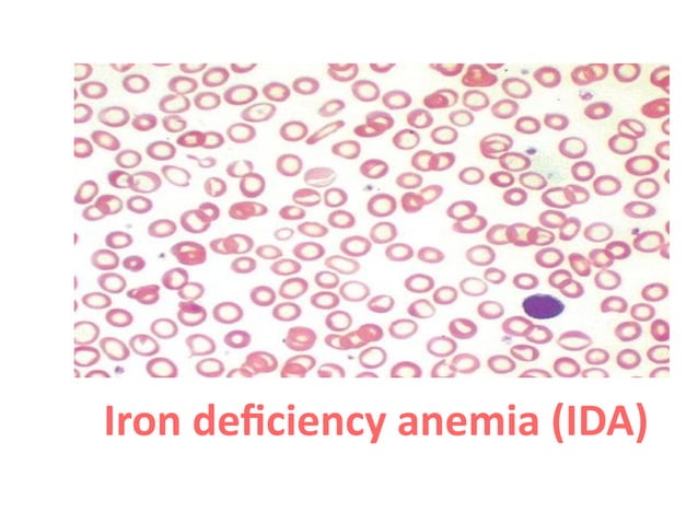 Approach to RBC disorders, anemia microcytic | PPT