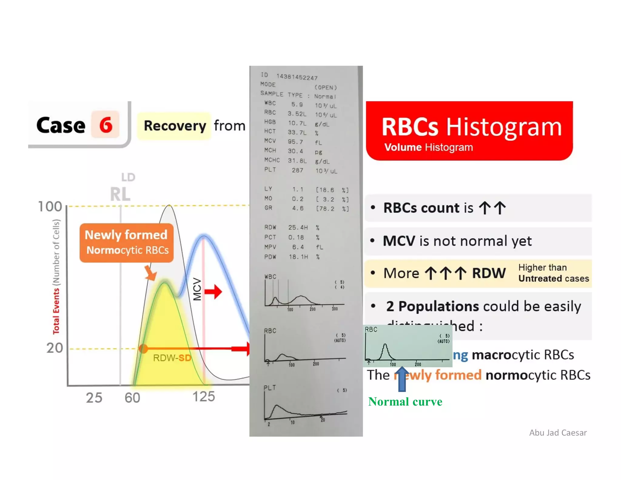 Updated - RBC histogram | PDF | Blood Disorders | Diseases and Conditions