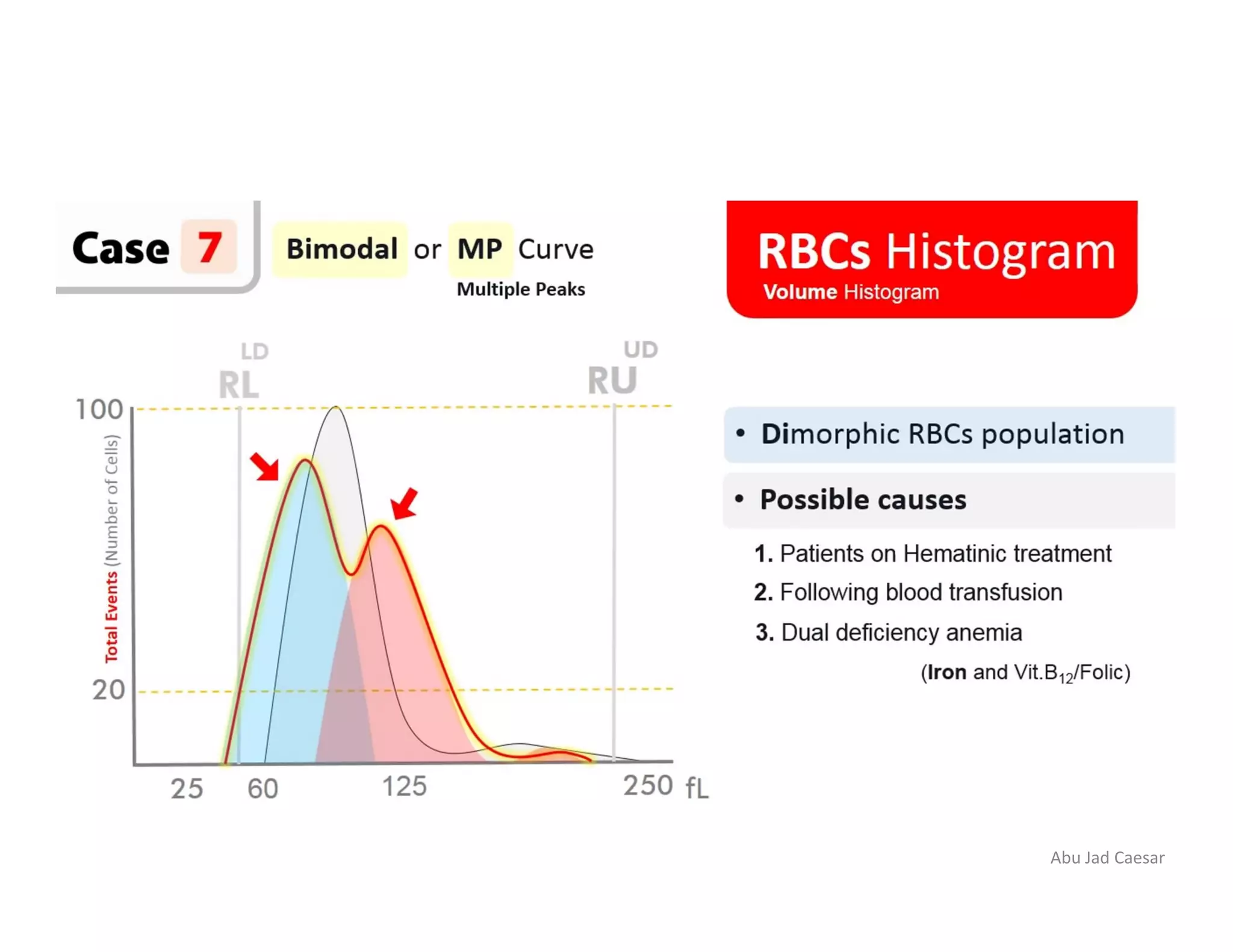 Updated - RBC histogram | PDF | Blood Disorders | Diseases and Conditions