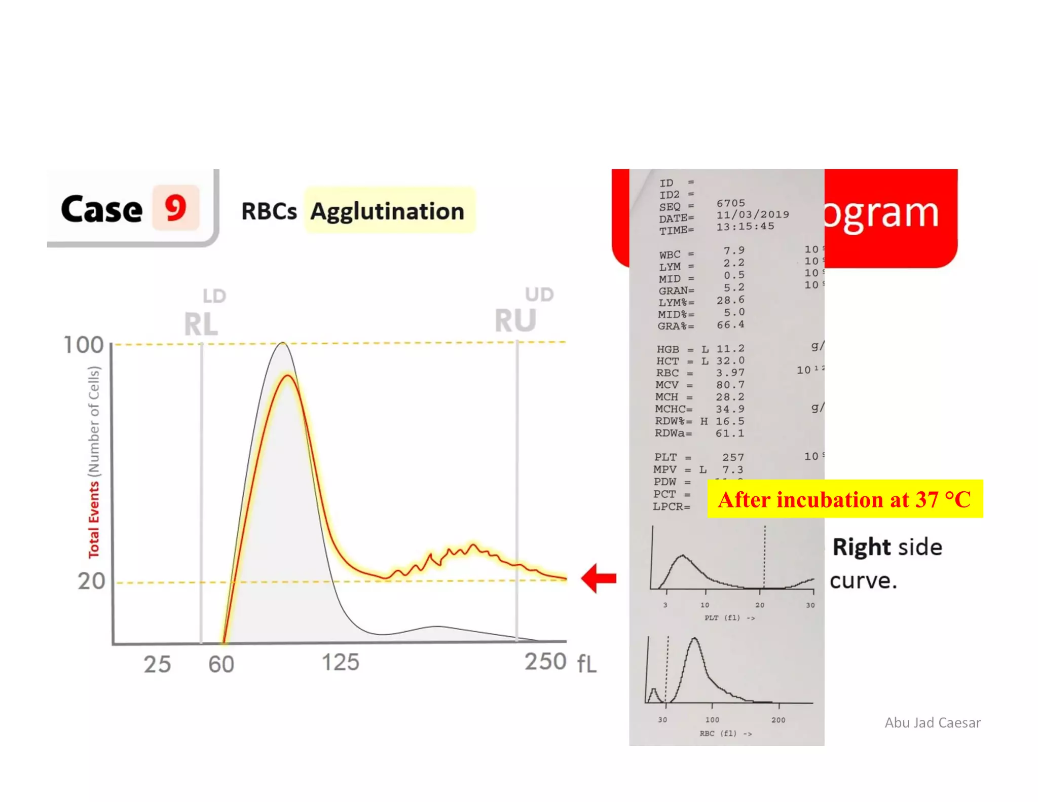Updated - RBC histogram | PDF | Blood Disorders | Diseases and Conditions