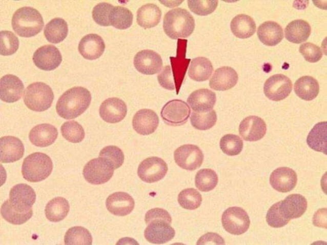 Rbc inclusion ()))))