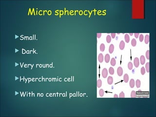RBC Membrane Defects | PPT