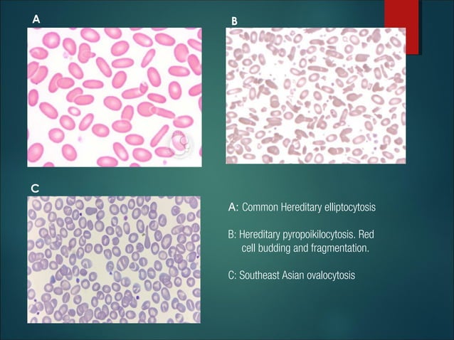 RBC Membrane Defects