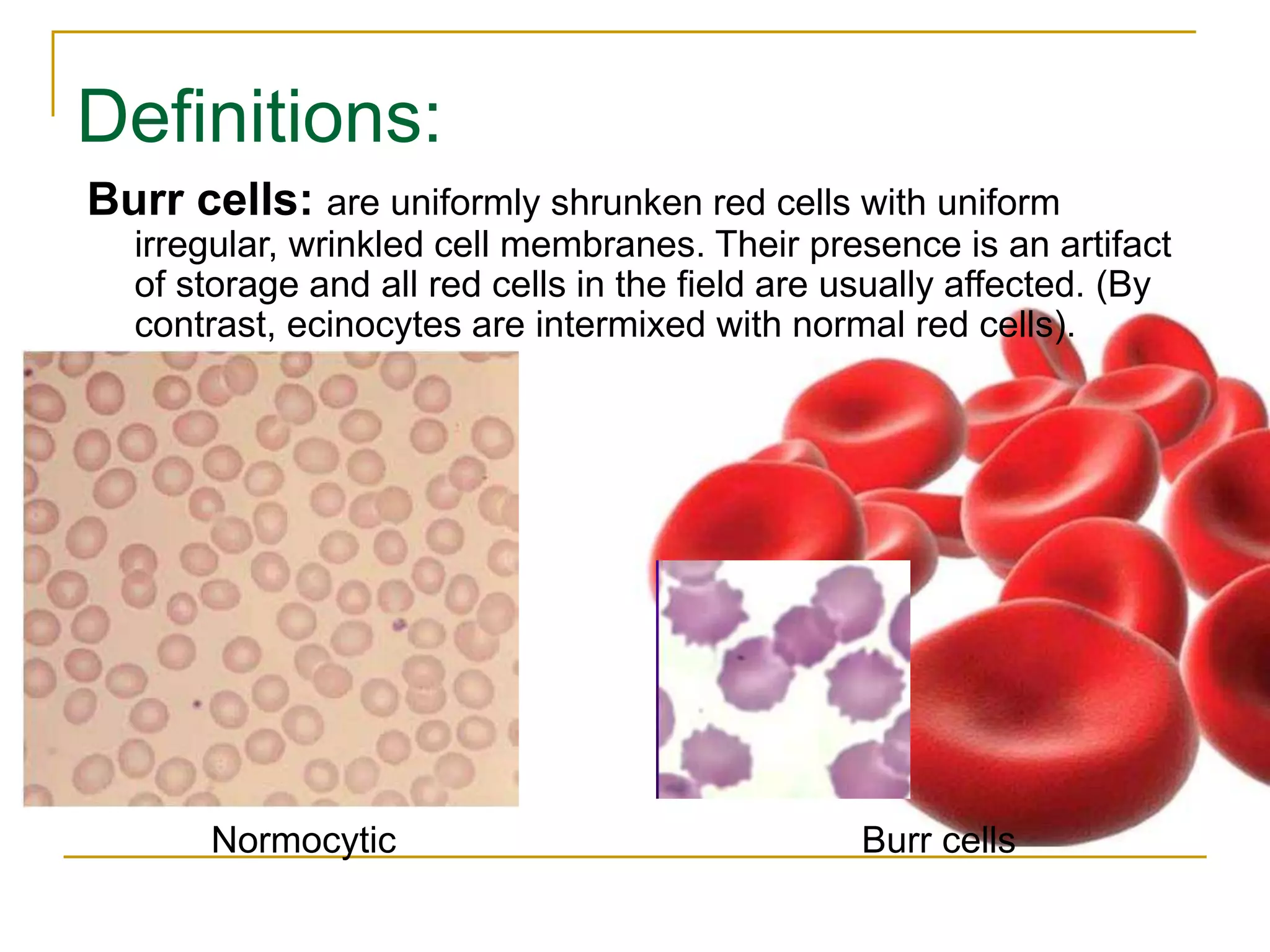 RBC morphology and Disease that may be associated with abnormal ...