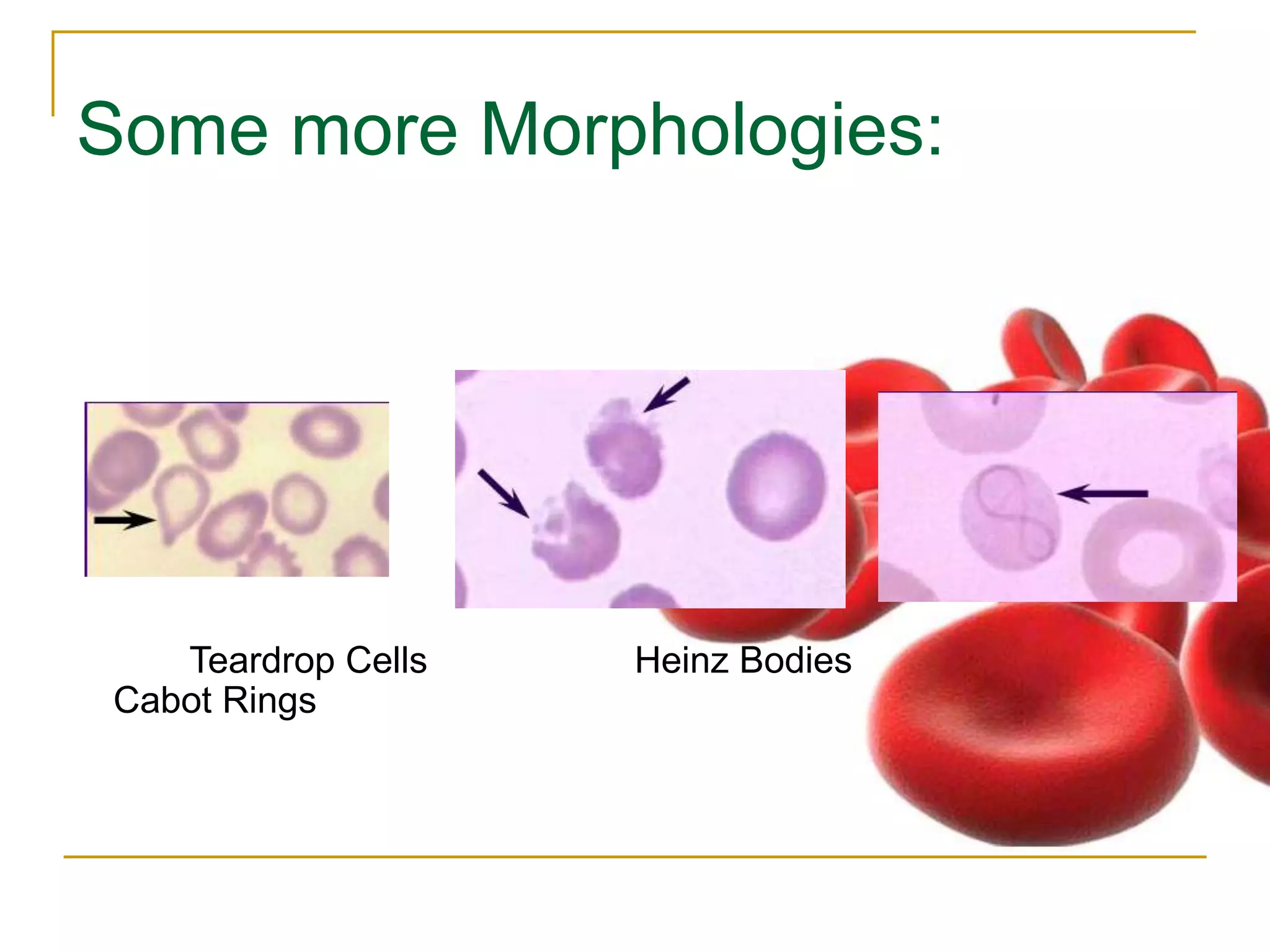 RBC morphology and Disease that may be associated with abnormal ...