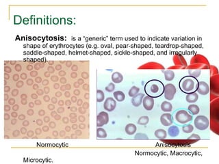 RBC morphology and Disease that may be associated with abnormal ...