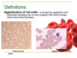 RBC morphology and Disease that may be associated with abnormal ...