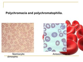 RBC morphology and Disease that may be associated with abnormal ...