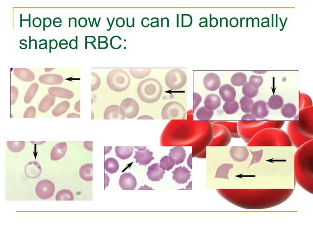 RBC morphology and Disease that may be associated with abnormal ...