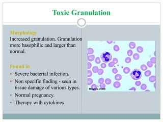Toxic Granulation Vs Basophil