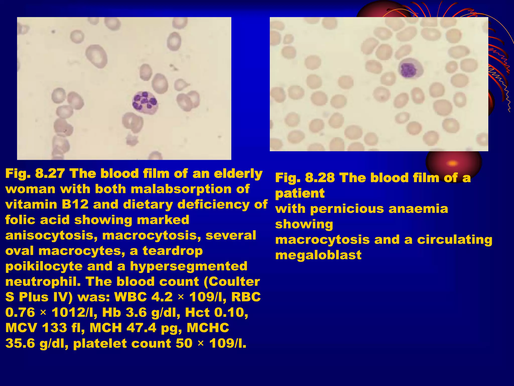 Rbc & wbc disorders( Dr. MURALI BM) | PPT