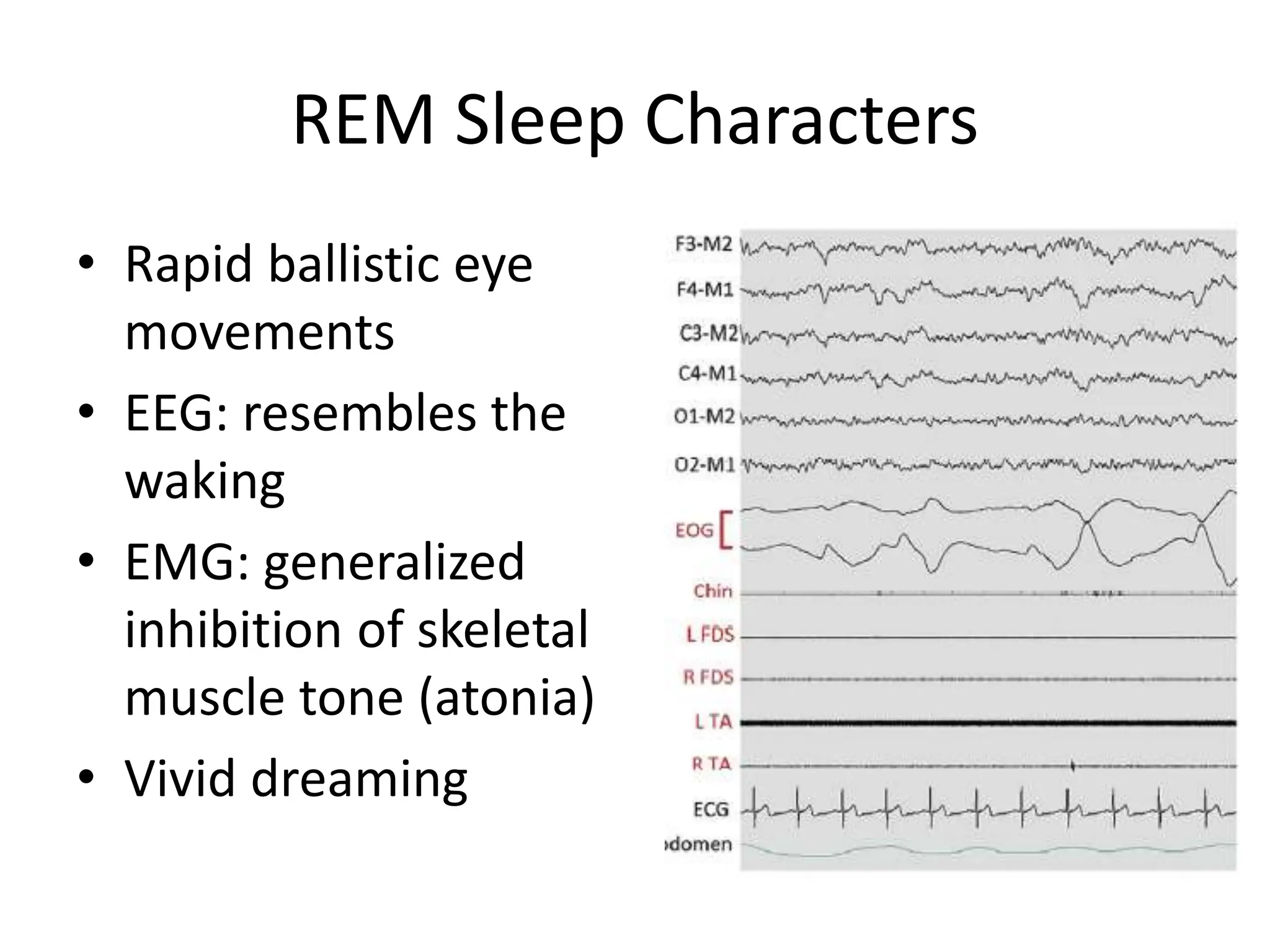 Rapid eye movement sleep behavior disorders | PPTX