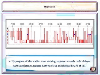 REM behaviour disorder and dementia with Lewy bodies | PPTX